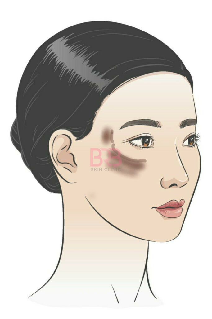 오타 모반 - 바라봄피부과의원