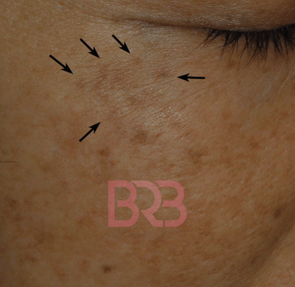 오타 모반 - 바라봄피부과의원